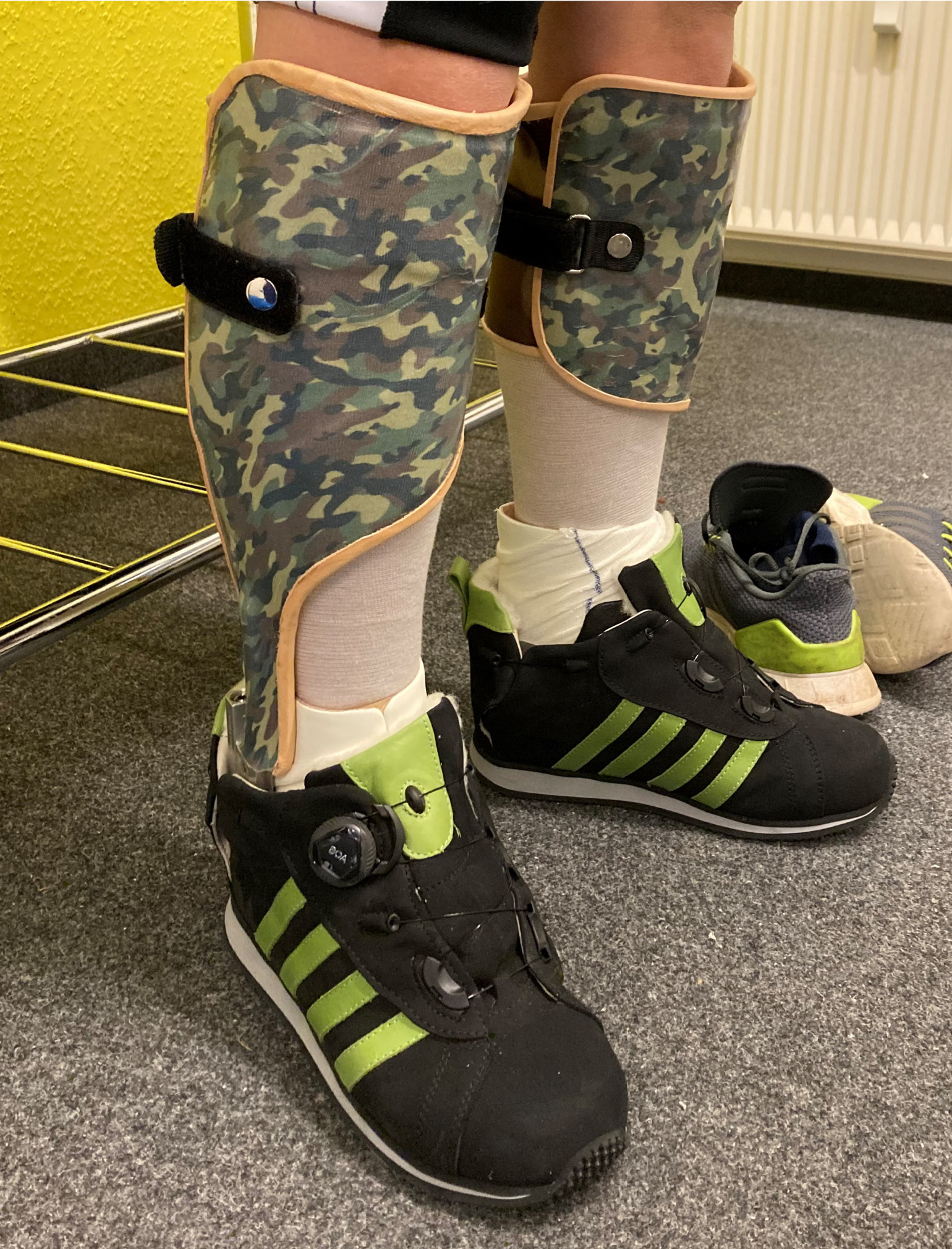 Angeborener Klumpfuß – Fuchs Orthopädietechnik
