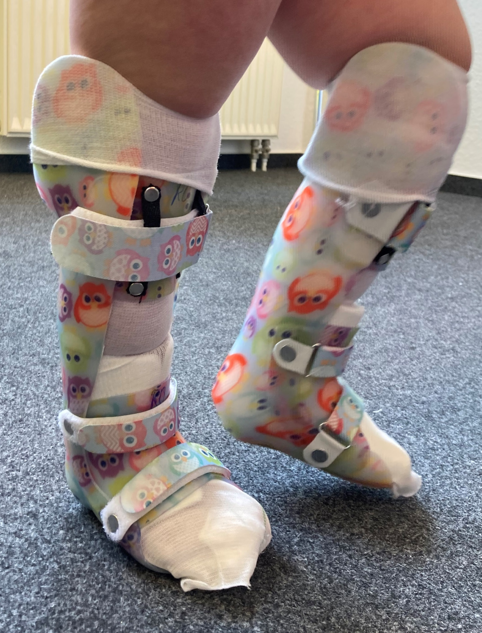 Angeborener Klumpfuß – Fuchs Orthopädietechnik